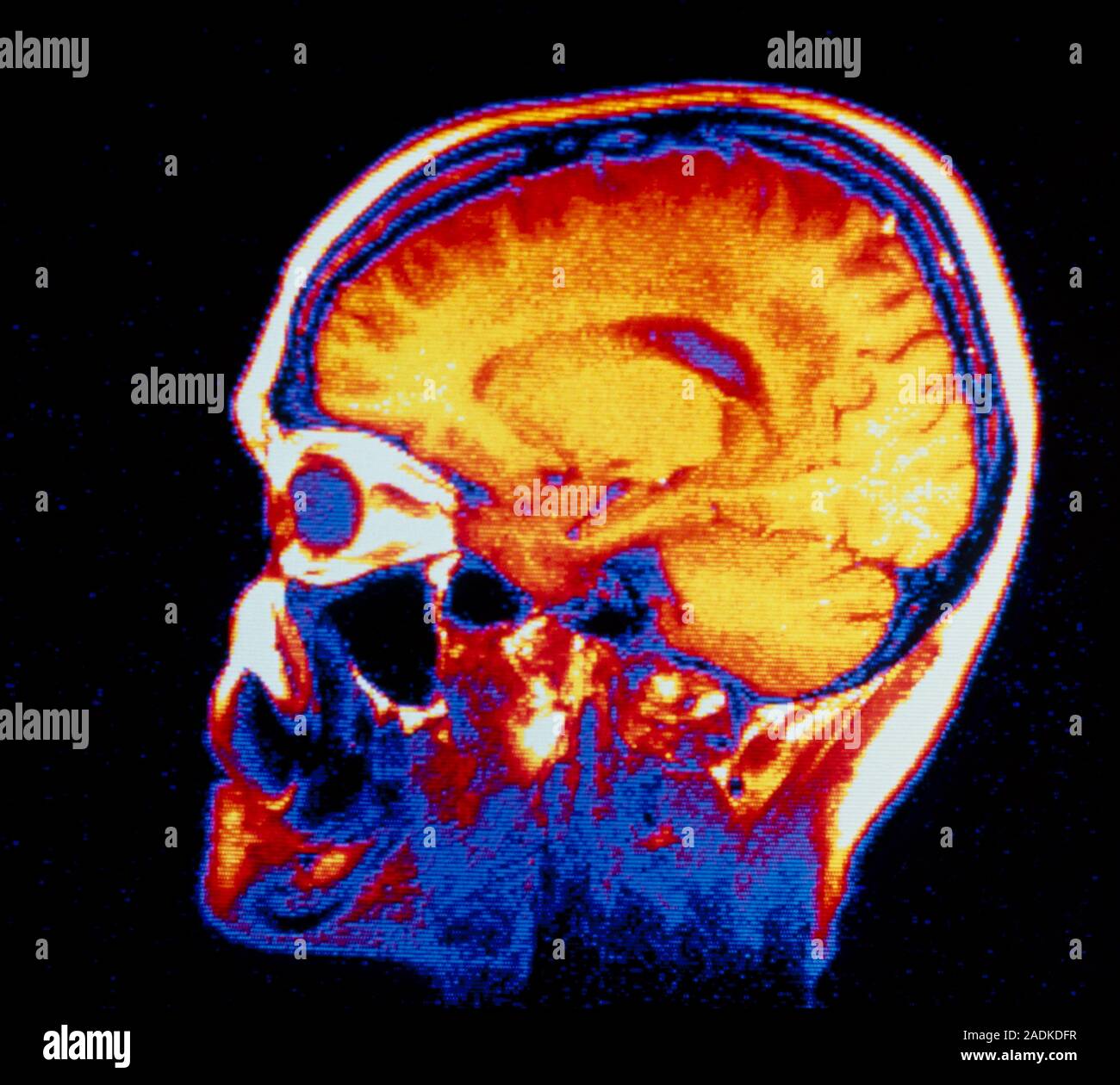 False-colour nuclear magnetic resonance (NMR) image of a sagittal ...
