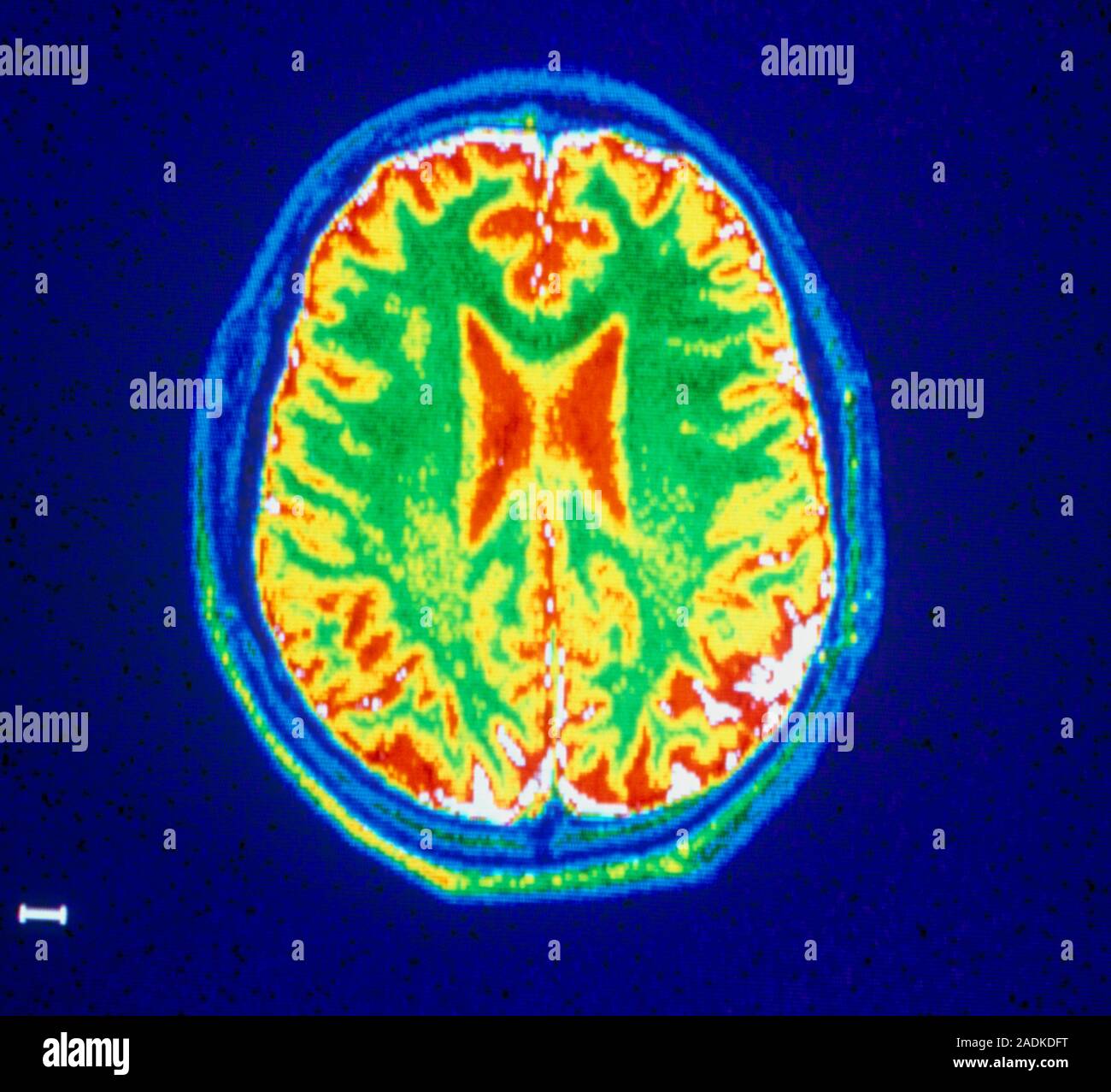 False-colour Magnetic Resonance Image (MRI) of an axial section through ...