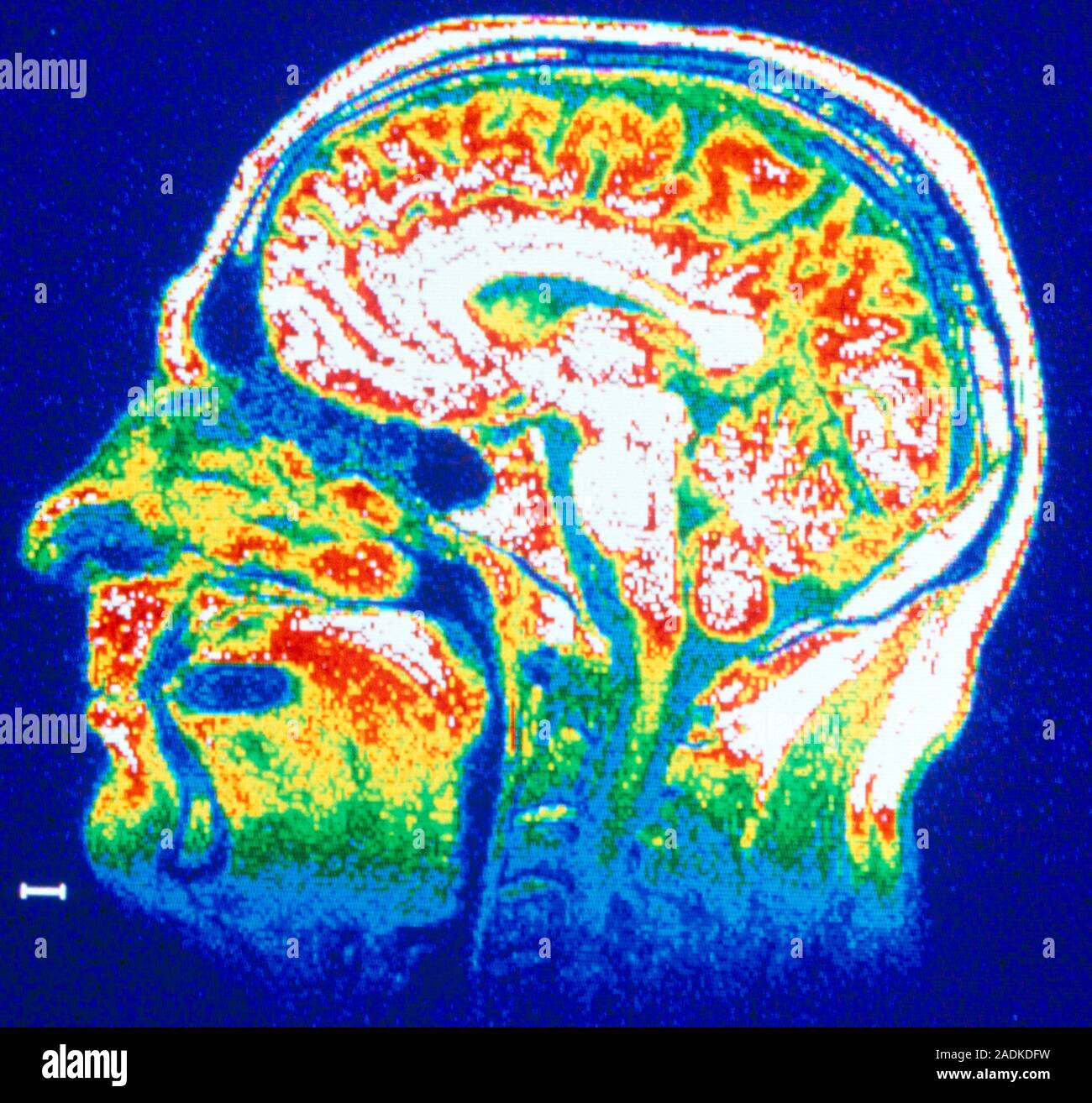 False-colour Magnetic Resonance Image (MRI) of a mid-sagittal section ...