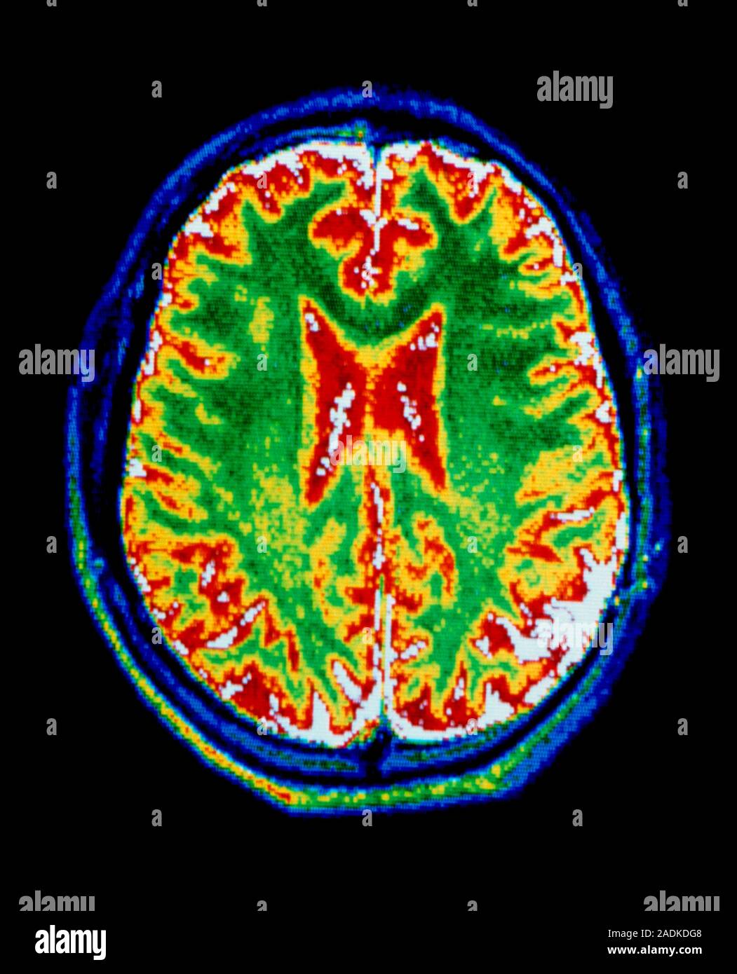 False-colour Magnetic Resonance Image (MRI) of an axial section through ...