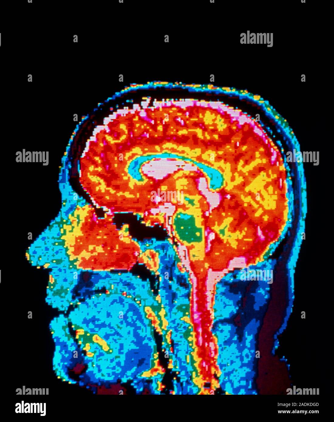 False-colour nuclear magnetic resonance (NMR) image of a sagittal ...