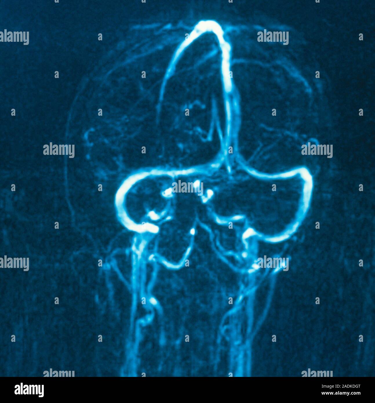 The cerebral circulation. Magnetic resonance image (MRI) revealing the ...