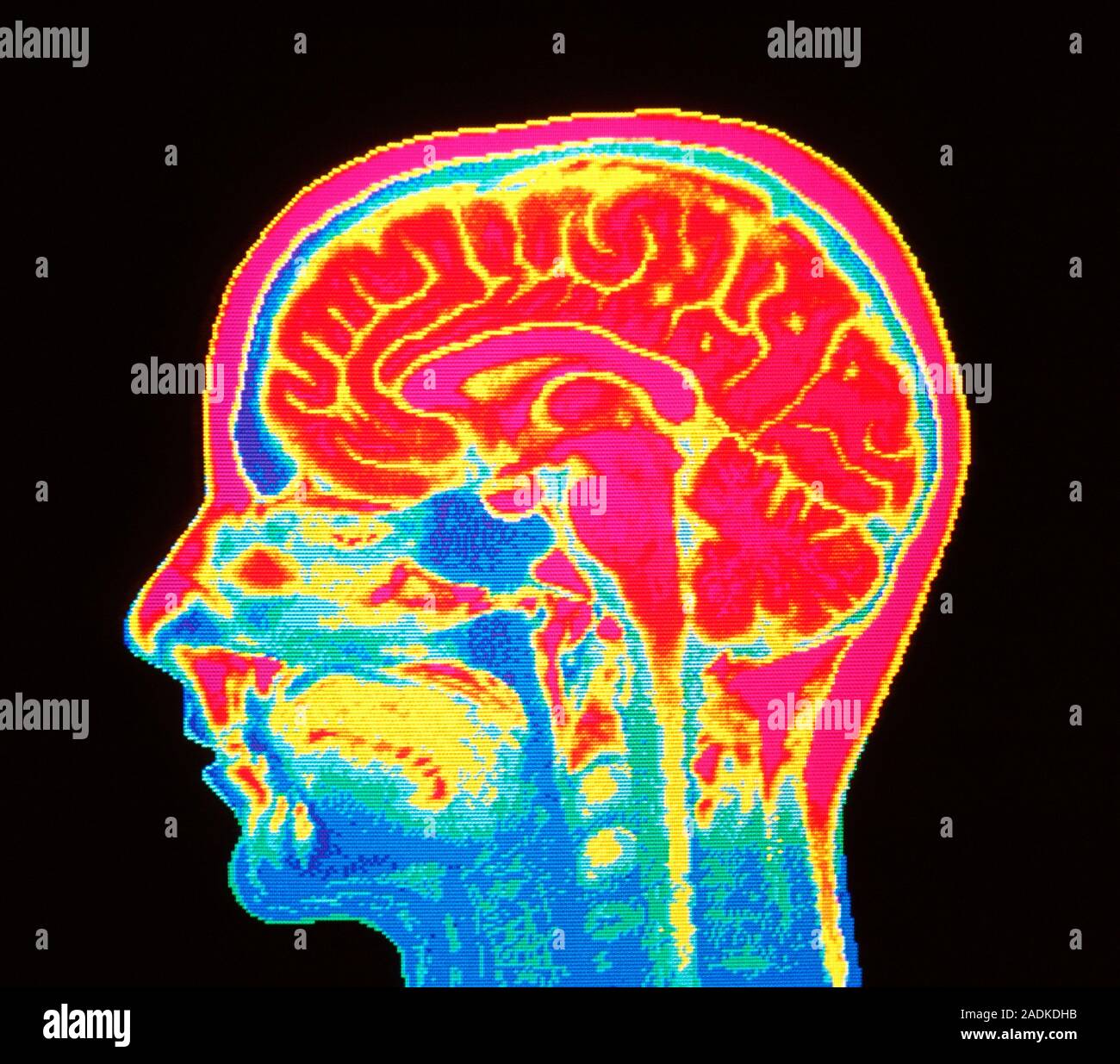 Coloured nuclear magnetic resonance (NMR) scan showing a normal brain ...