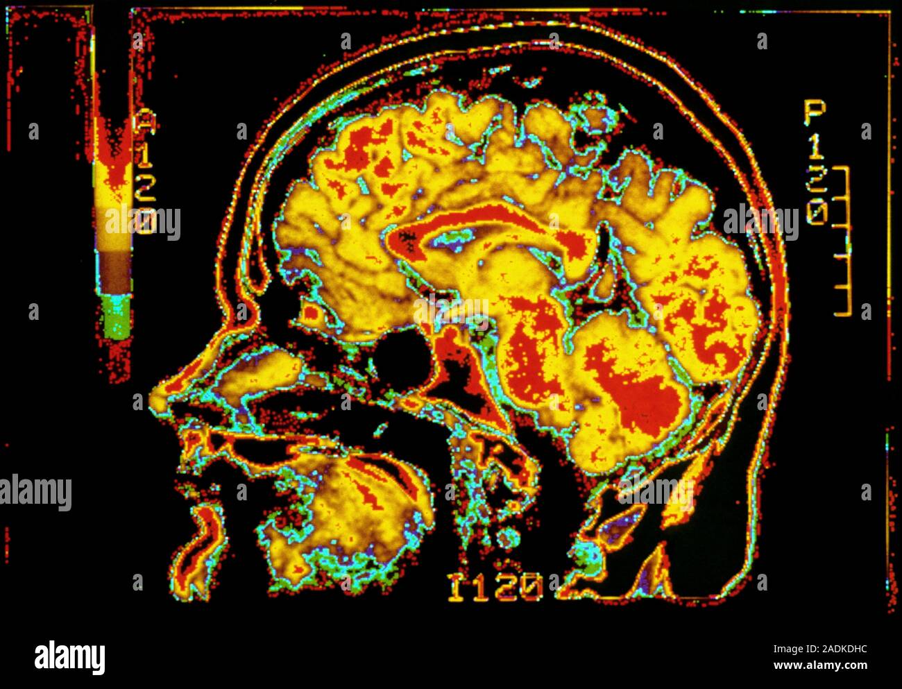 Head scan. Coloured Magnetic Resonance Imaging (MRI) scan of a male ...