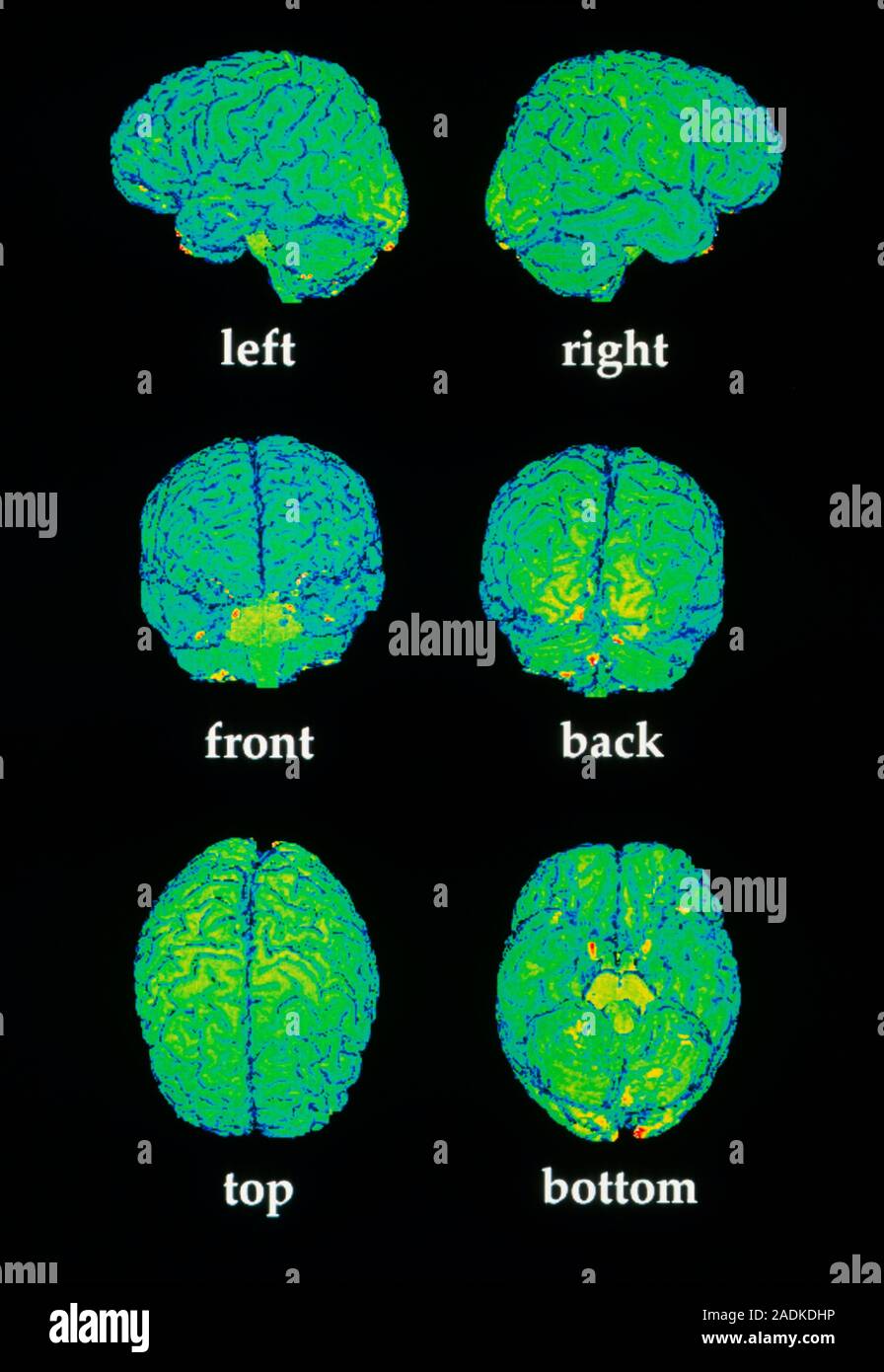 Healthy brain. Coloured three-dimensional Magnetic Resonance Image (MRI) scans of the human ...