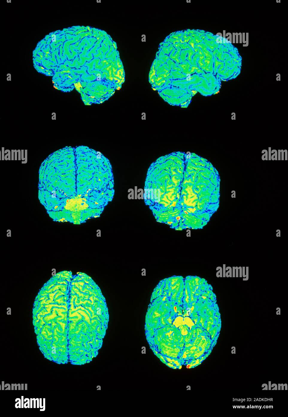 Healthy brain. Coloured three-dimensional Magnetic Resonance Image (MRI) scans of the human ...