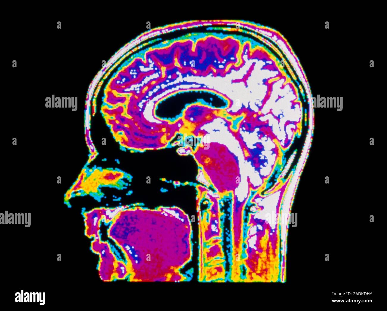 Brain scan. Coloured magnetic resonance imaging (MRI) scan of a normal ...