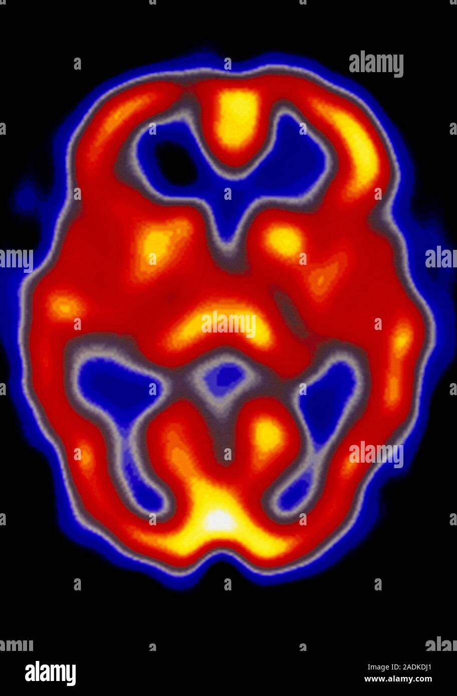 Spect Brain Scan