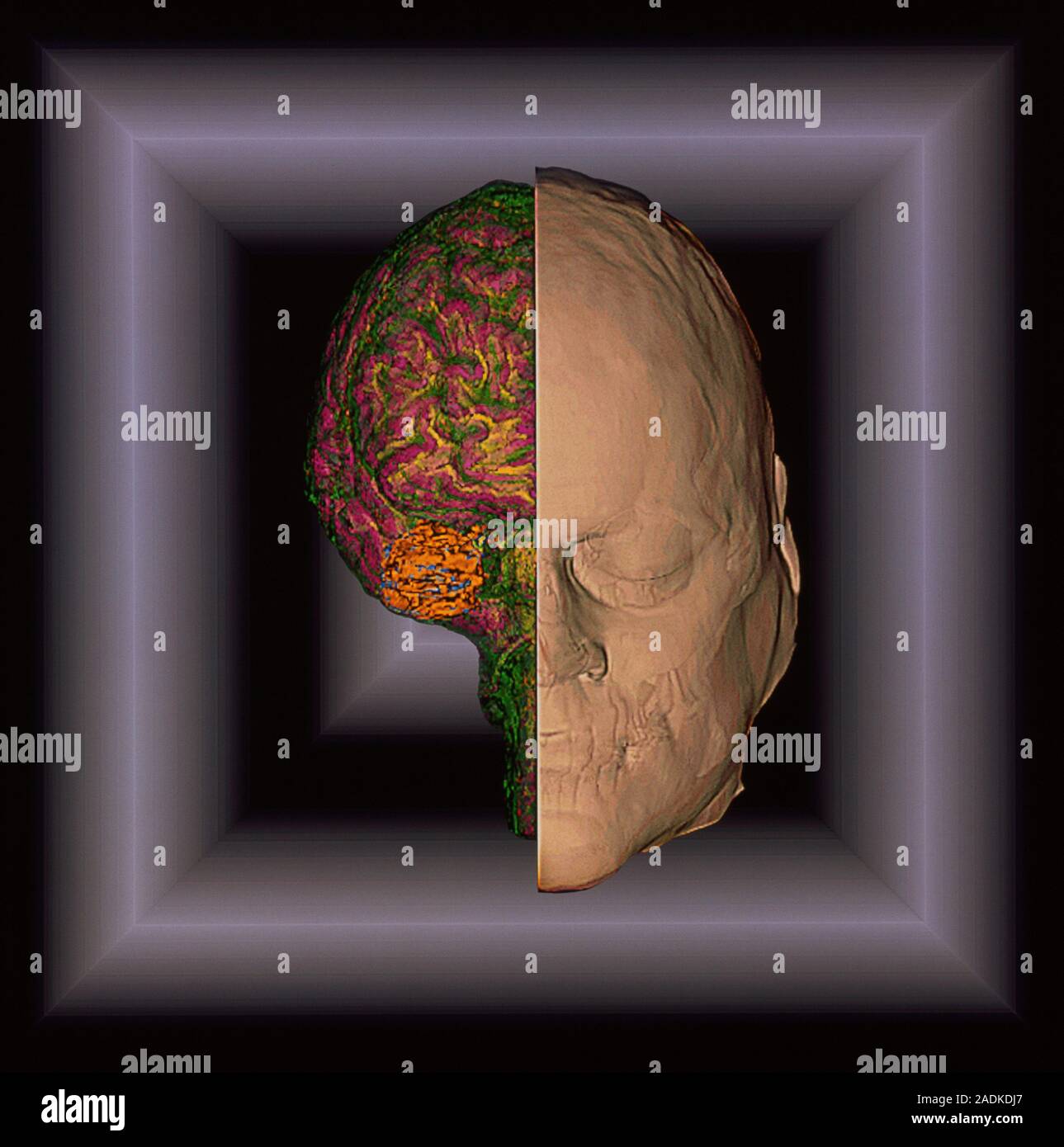 Brain in the skull. Coloured three-dimensional scan of the brain and ...