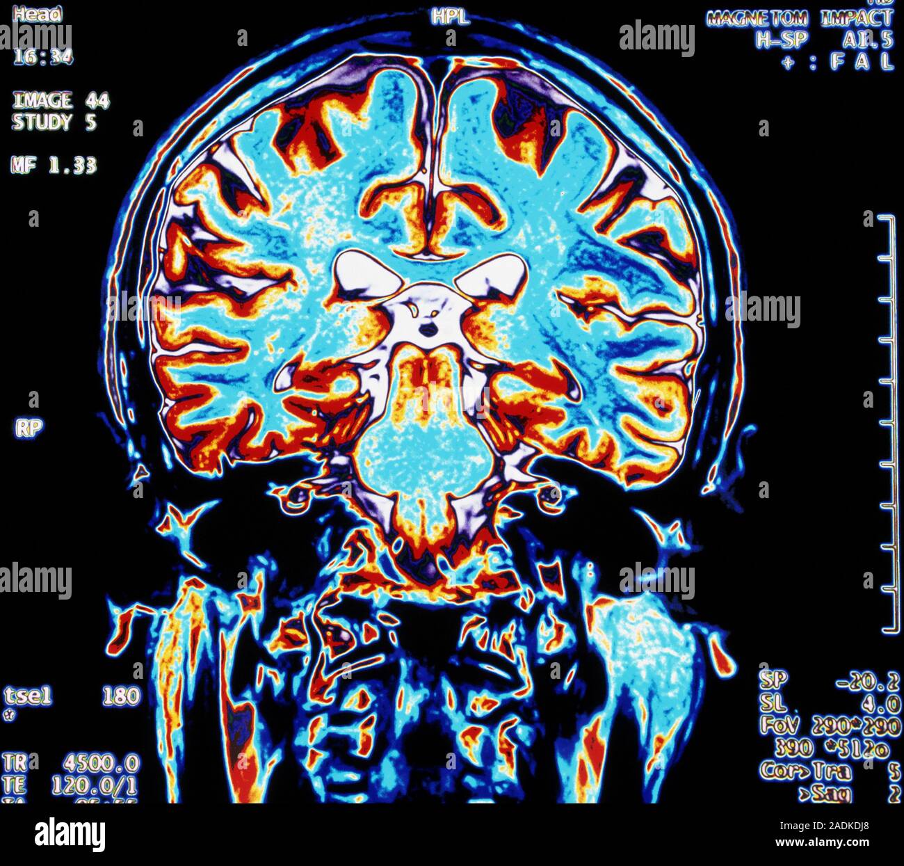 Healthy brain. Coloured Magnetic Resonance Image (MRI) scan through the ...
