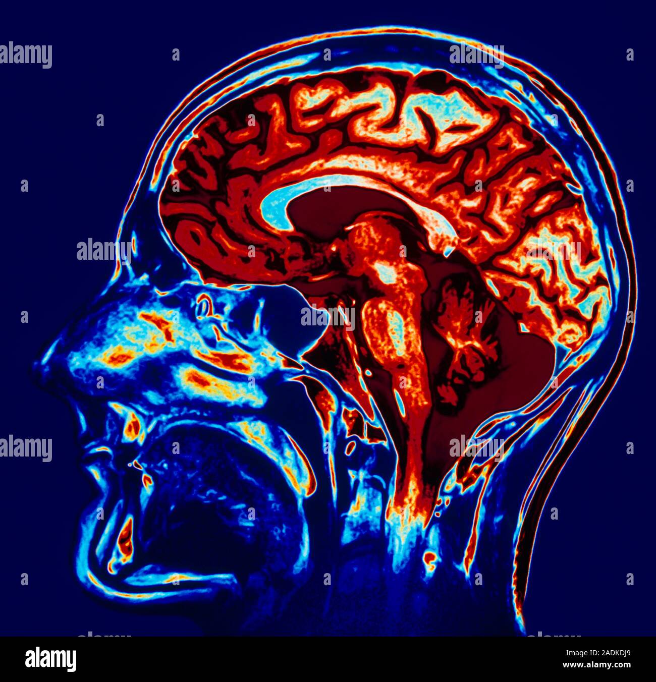 Healthy brain. Coloured Magnetic Resonance Imaging (MRI) scan of a healthy human brain seen in a ...