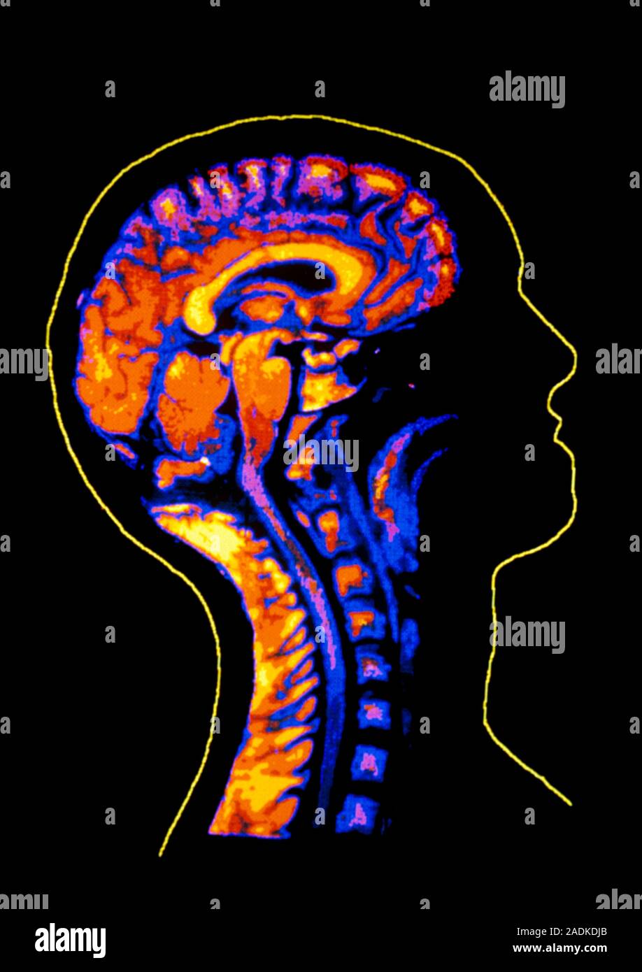 Healthy brain. Coloured Magnetic Resonance Imaging (MRI) scan of a ...