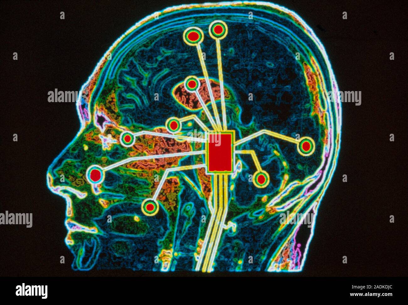 Human brain. Coloured Magnetic Resonance Imaging (MRI) scan of a human ...