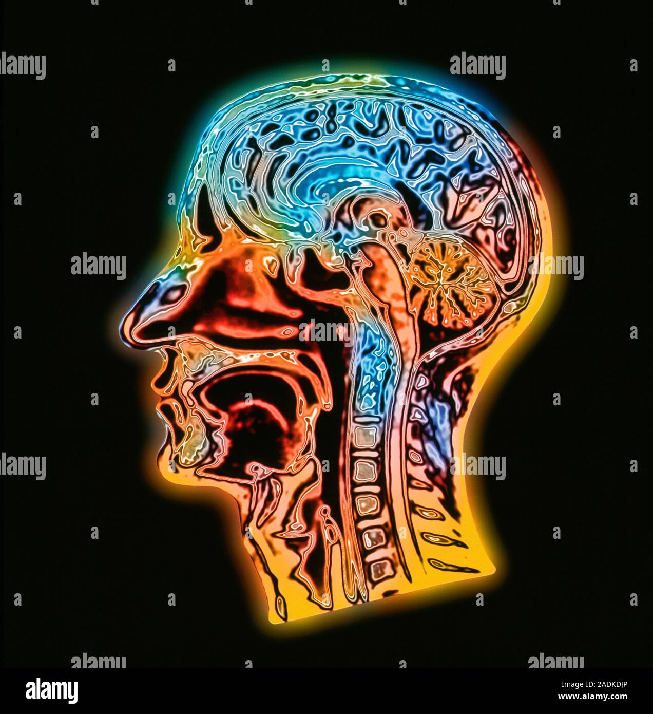 Brain scan. Coloured Magnetic Resonance Imaging (MRI) scan through a ...
