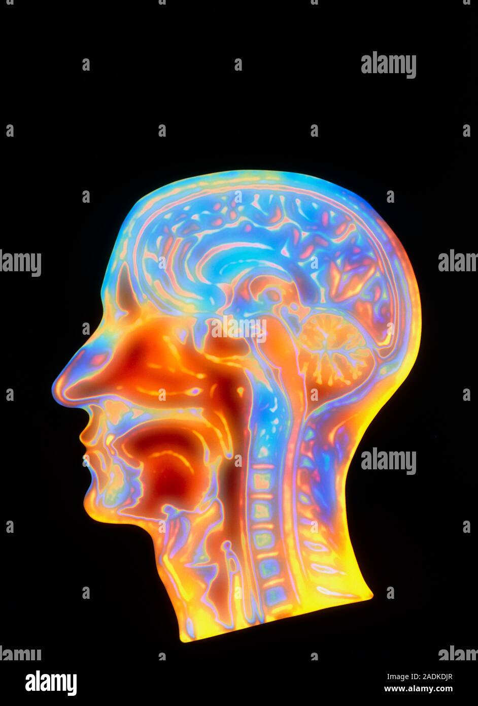 Brain scan. Coloured Magnetic Resonance Imaging (MRI) scan through a ...
