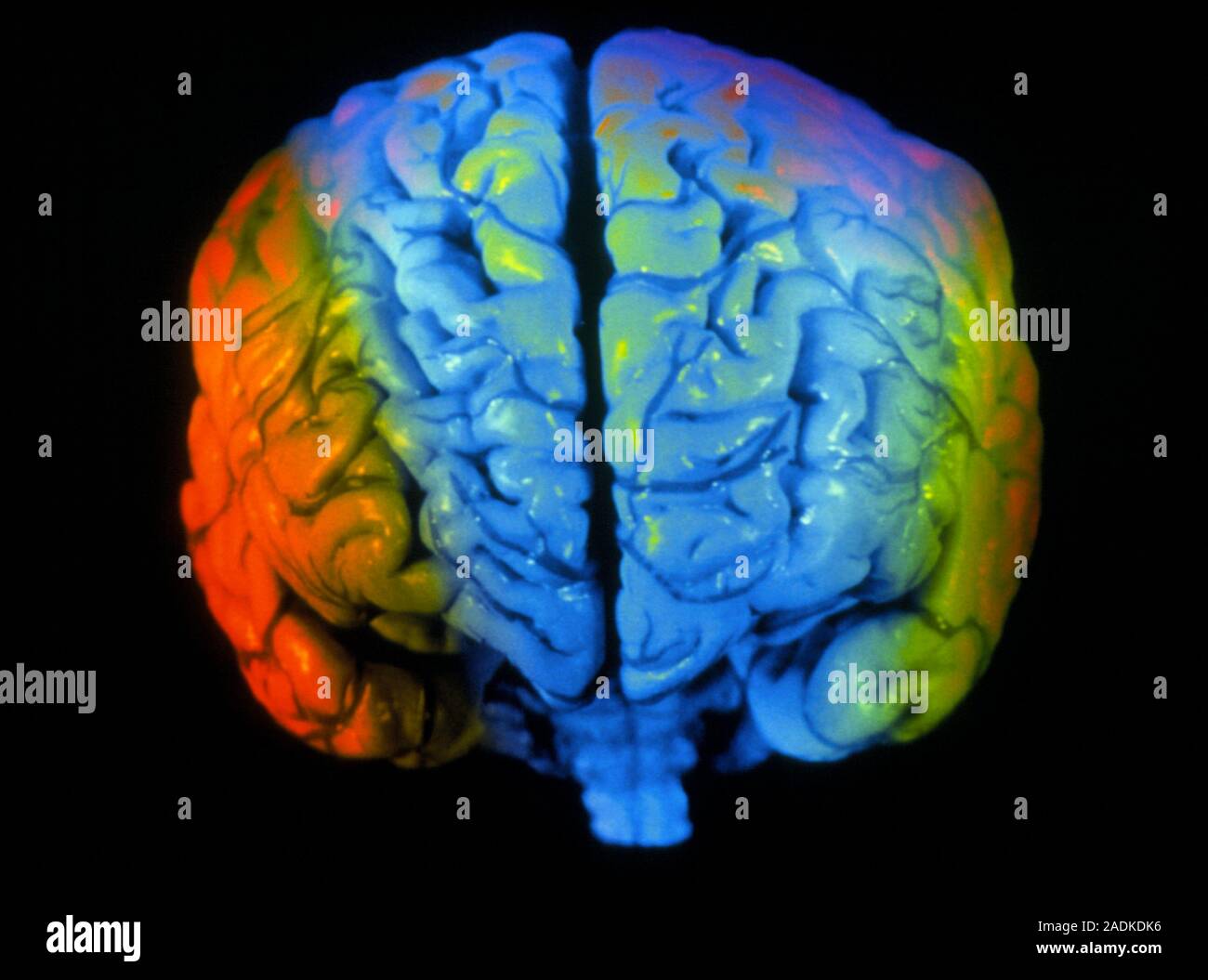 3-D MRI brain scan. Coloured three-dimensional magnetic resonance imaging (MRI) scan of a ...