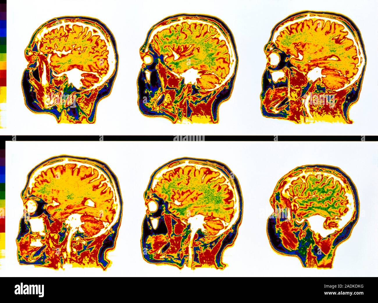 Brain MRI scans. Coloured magnetic resonance imaging (MRI) scans of sagittal sections of the ...