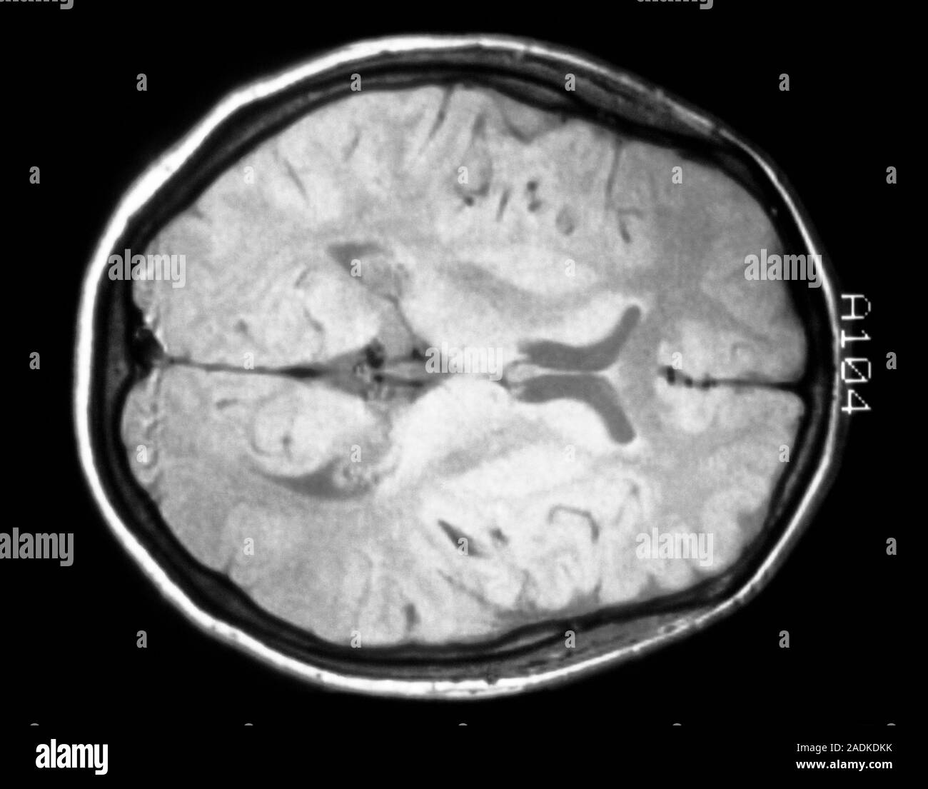 Healthy brain. Magnetic resonance imaging (MRI) scan of a healthy human ...