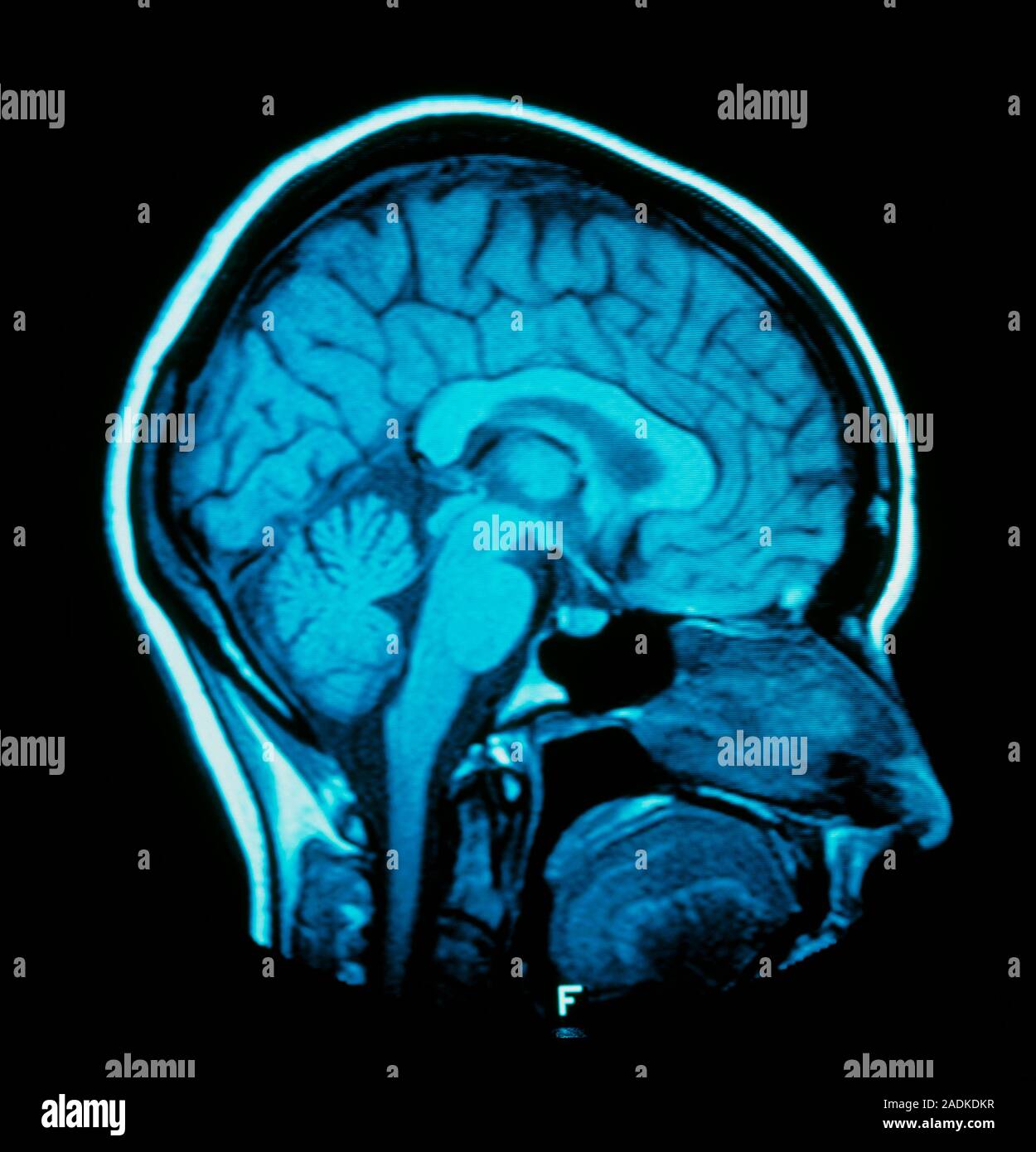 Healthy brain. Coloured magnetic resonance imaging (MRI) scan of a sagittal section of a human ...