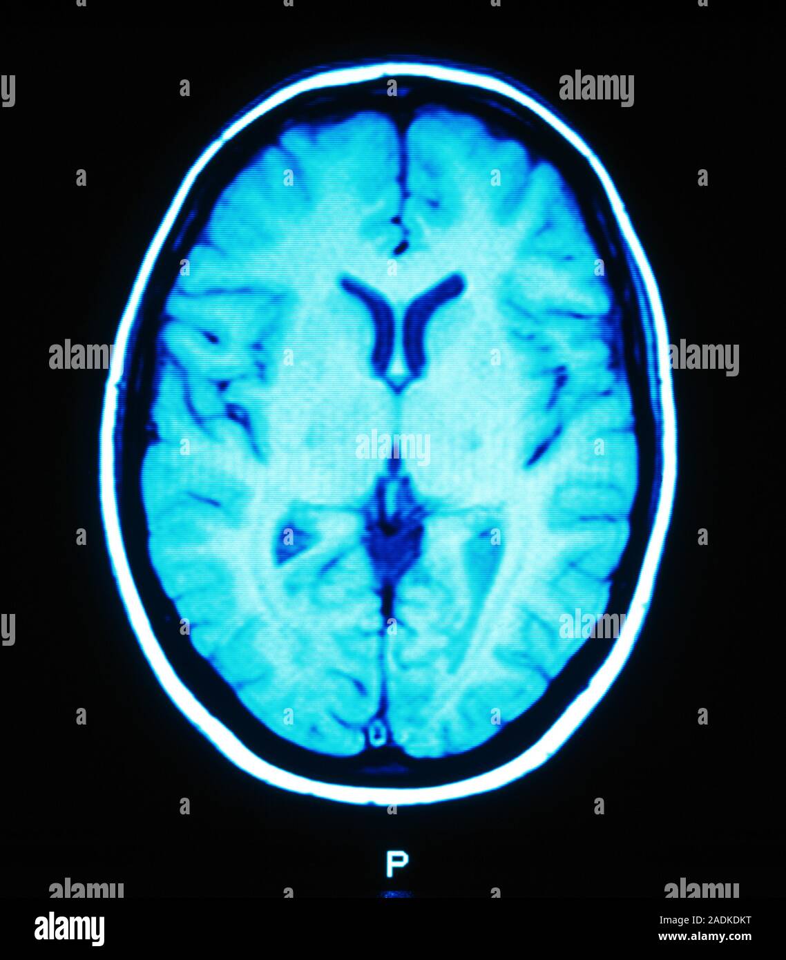 Healthy brain. Coloured magnetic resonance imaging (MRI) scan of an axial section of the human ...