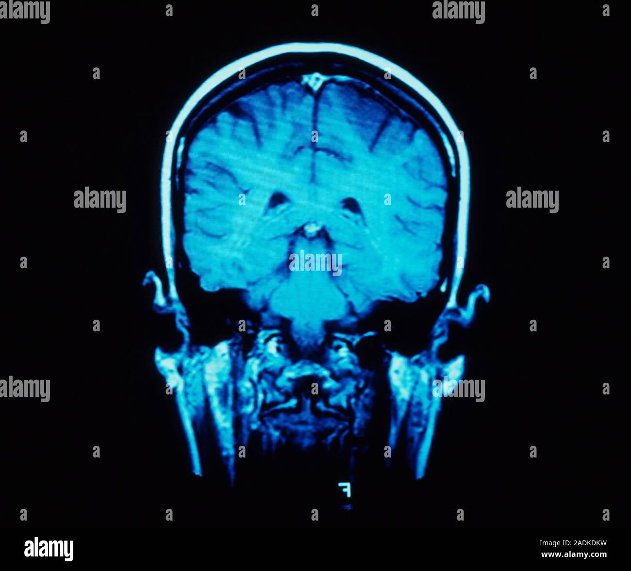 Healthy brain. Coloured magnetic resonance imaging (MRI) scan of a ...