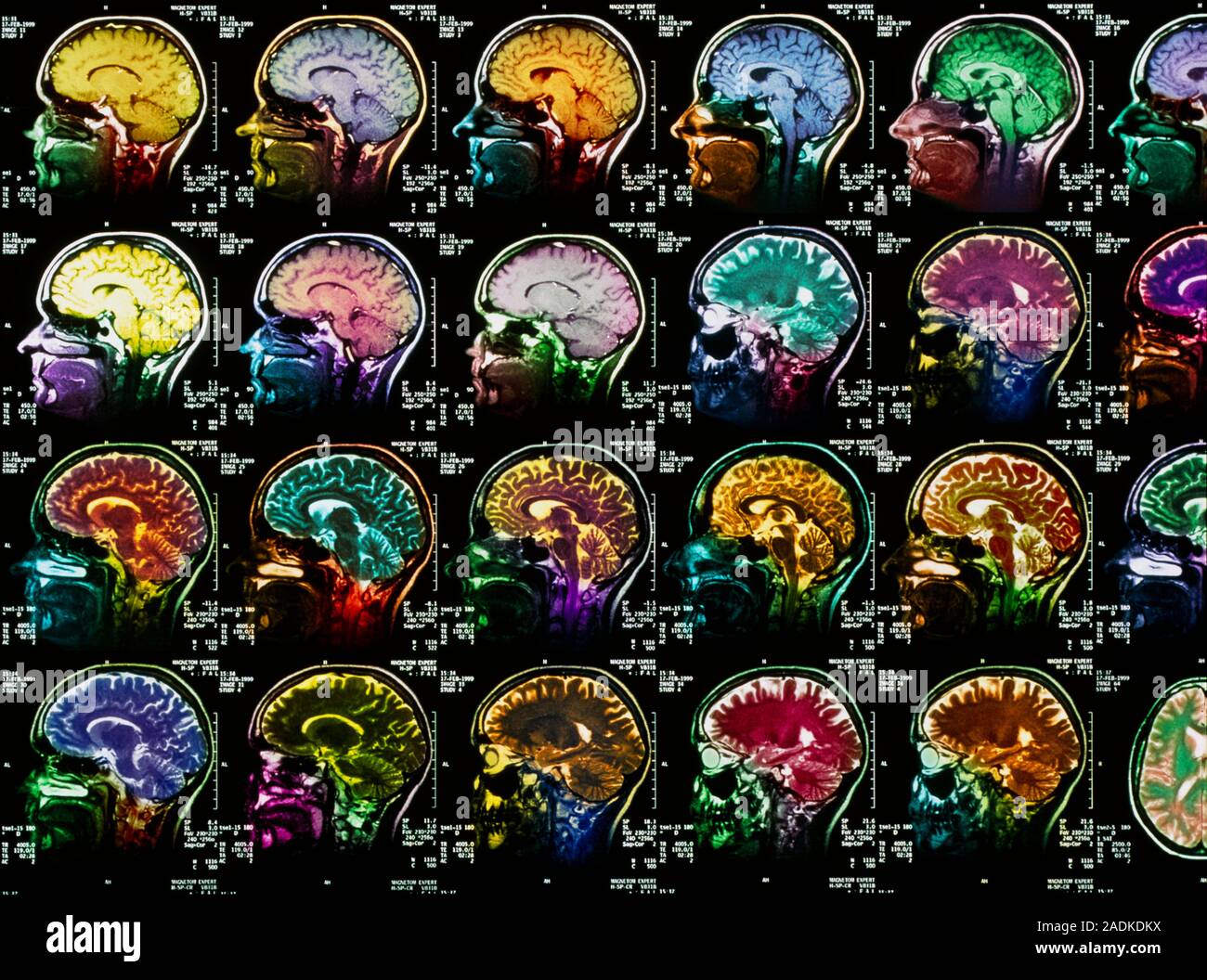 Brain scans. Coloured magnetic resonance imaging (MRI) scans through a human head showing a ...