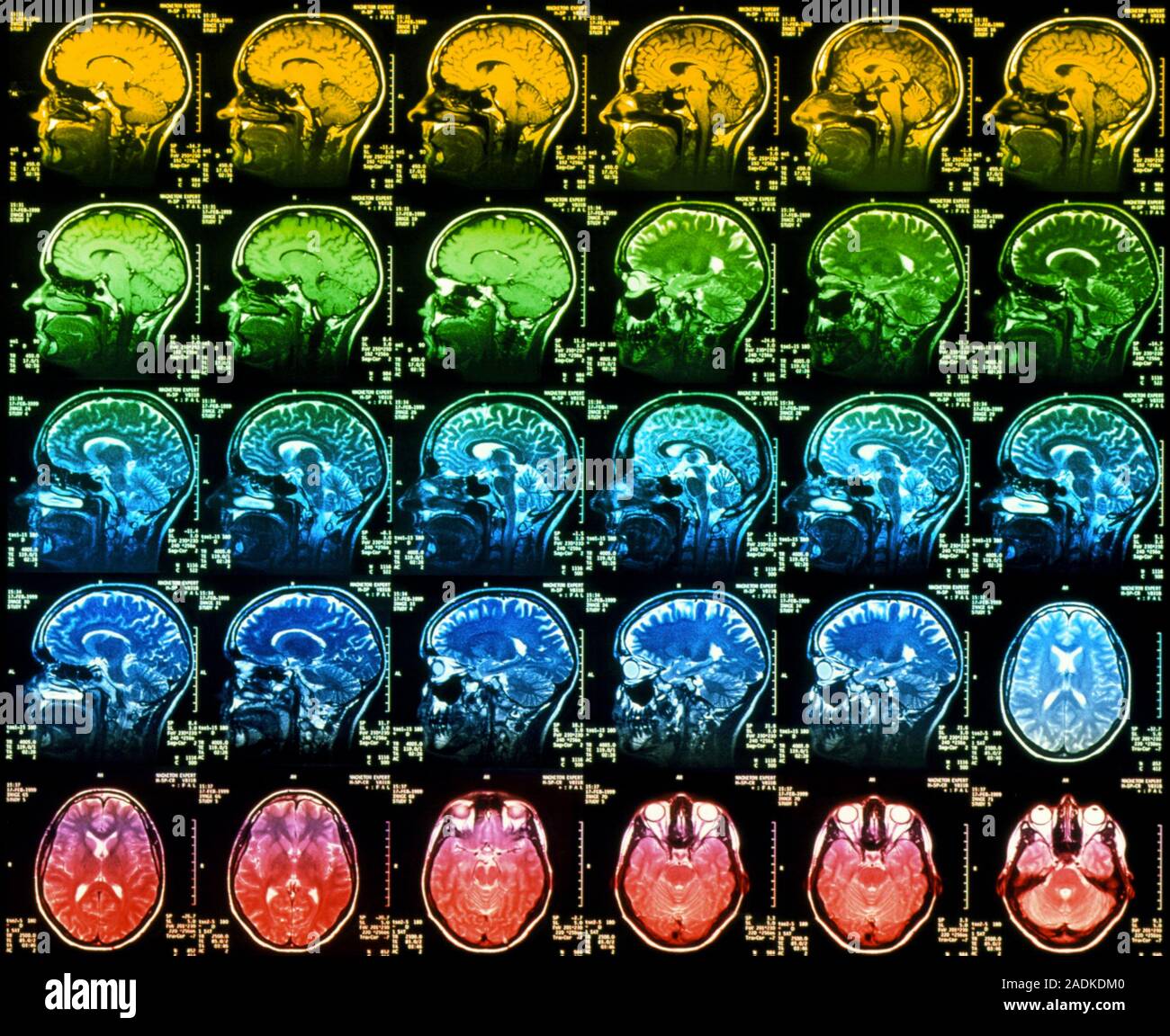 Brain scans. Coloured magnetic resonance imaging (MRI) scans through a human head showing a ...