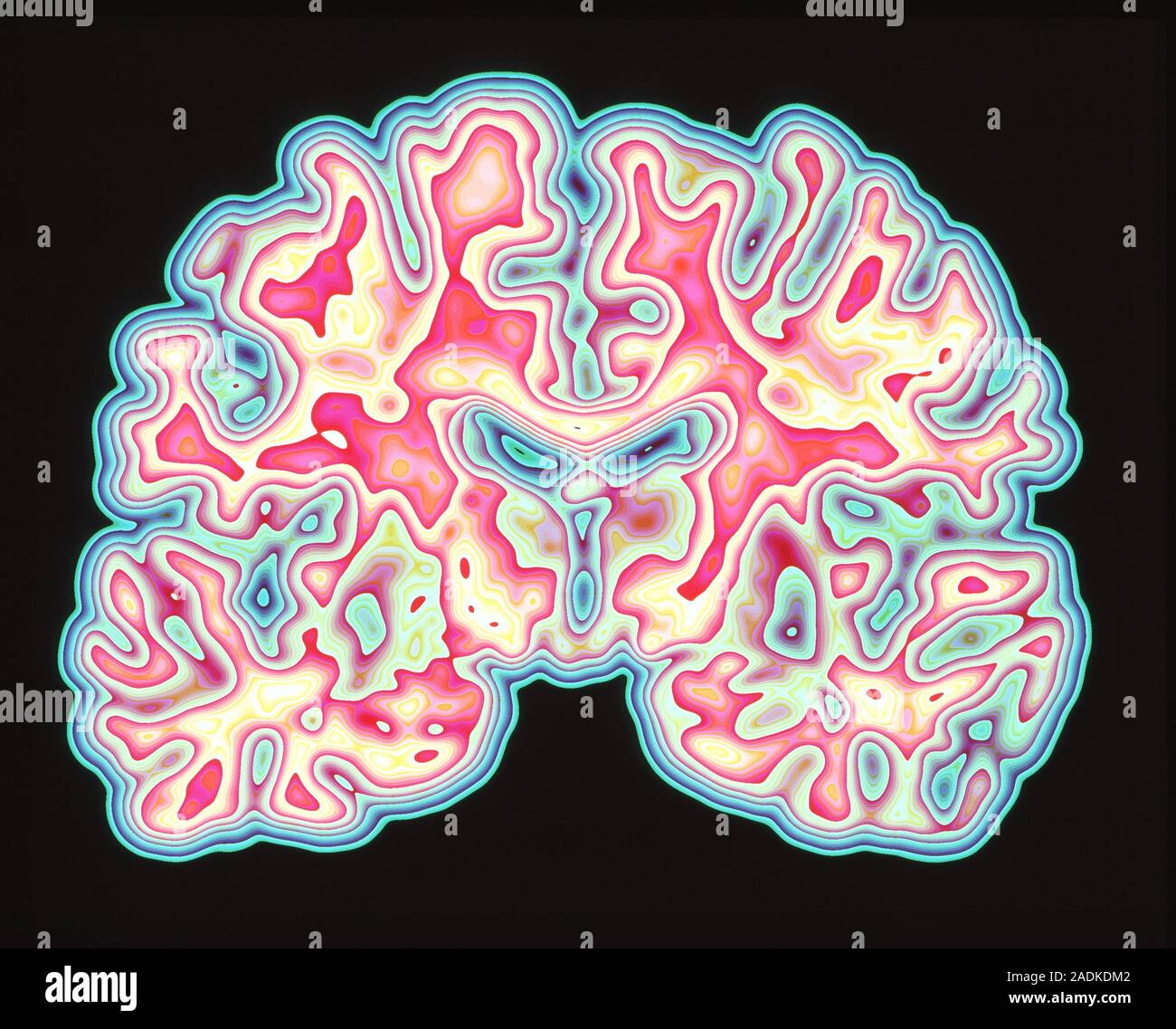 Brain. Coloured computed tomography (CT) scan of a section through a ...