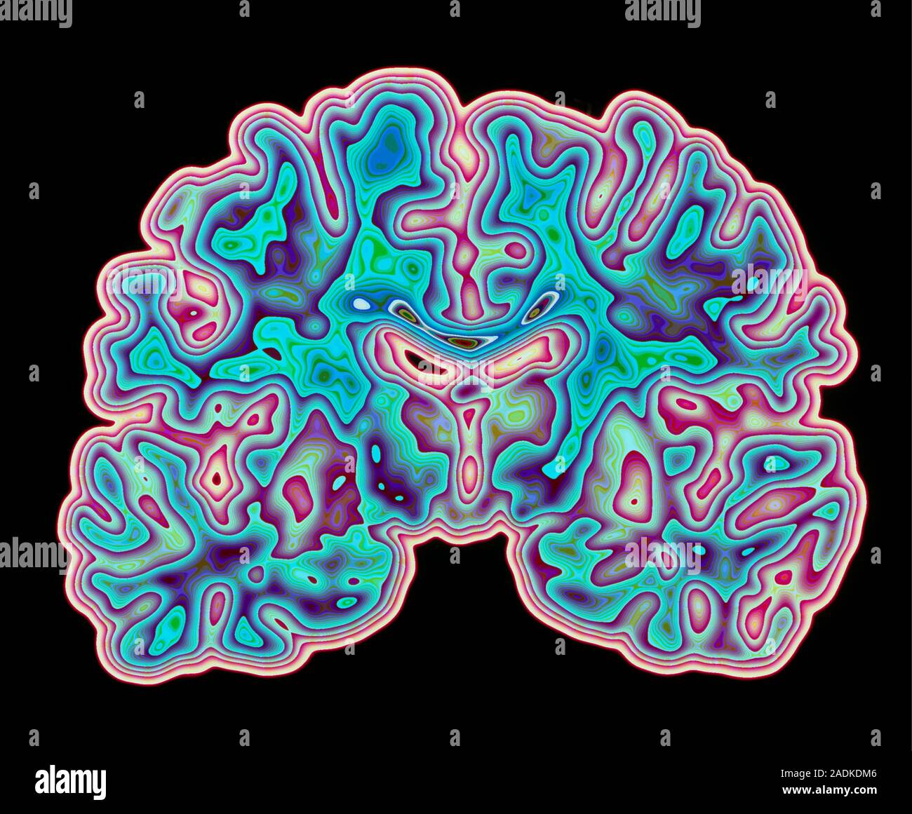 Brain. Coloured computed tomography (CT) scan of a section through a healthy human brain. The ...