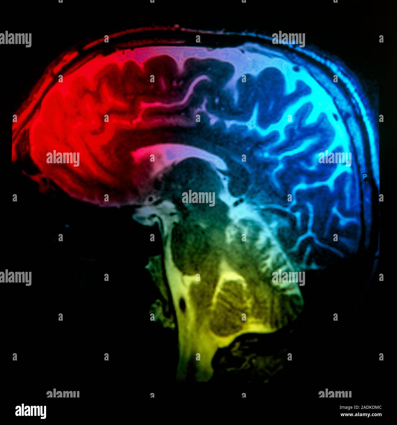 Healthy brain. Coloured magnetic resonance imaging (MRI) scan of a section through a human brain ...