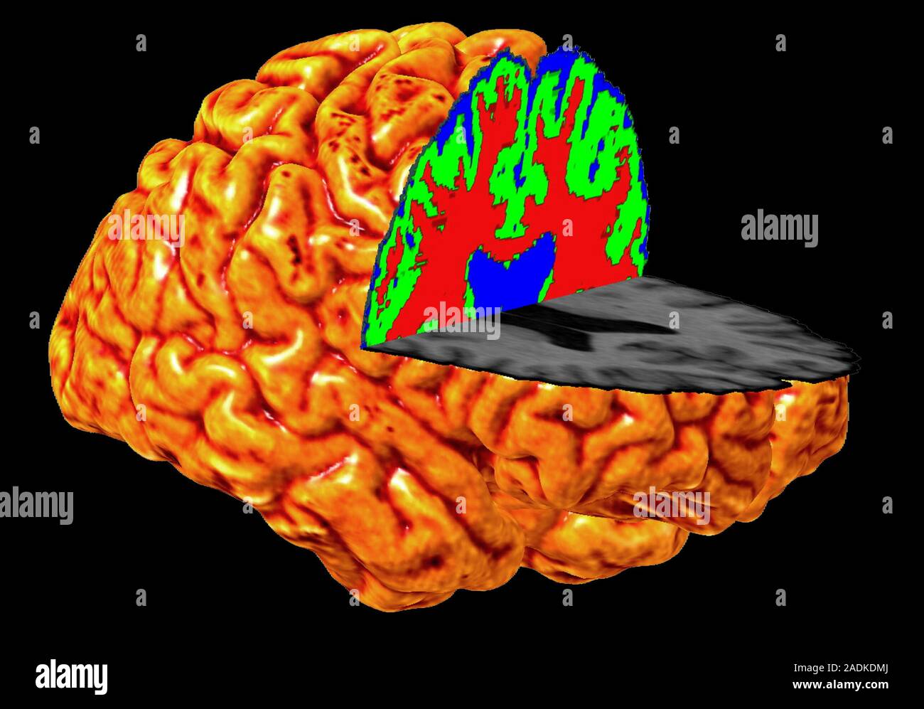 3-D brain scan. Coloured three-dimensional (3-D) magnetic resonance imaging (MRI) scan of a ...