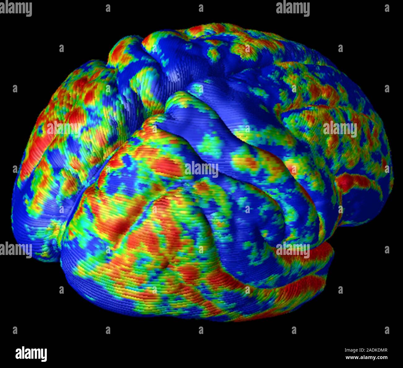 Brain variation. Coloured composite three- dimensional scan of ...