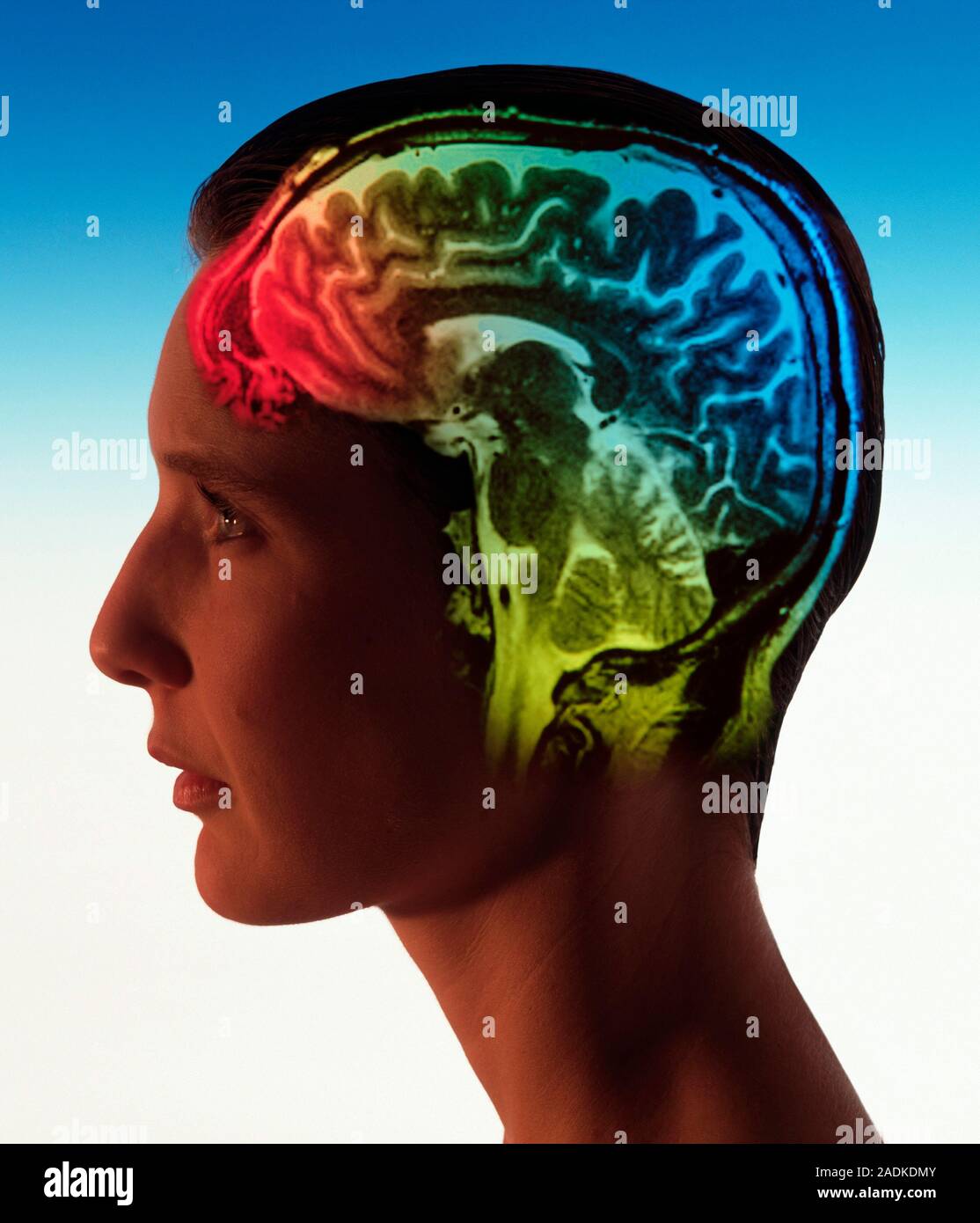 Brain scan. Coloured magnetic resonance imaging (MRI) scan of a ...