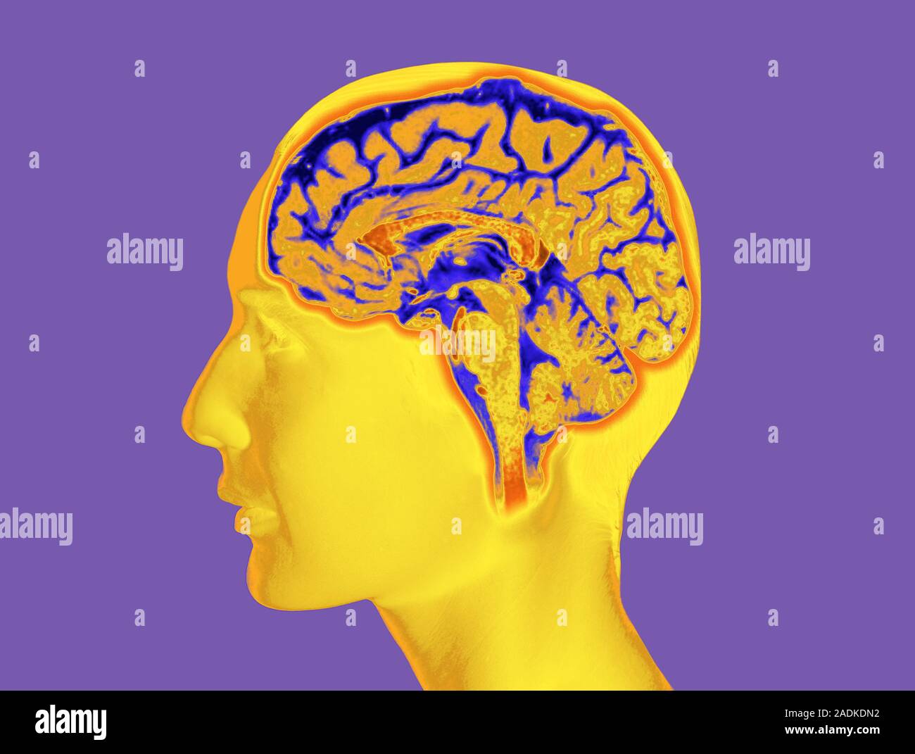 Brain scan. Coloured magnetic resonance imaging (MRI) scan of a ...