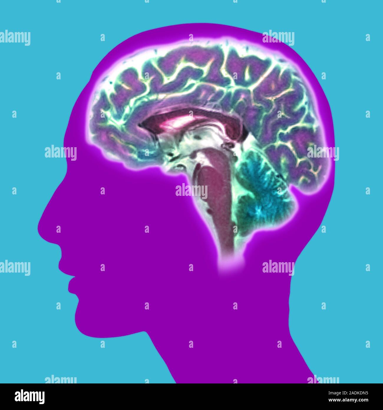 Brain scan. Coloured magnetic resonance imaging (MRI) scan of a ...