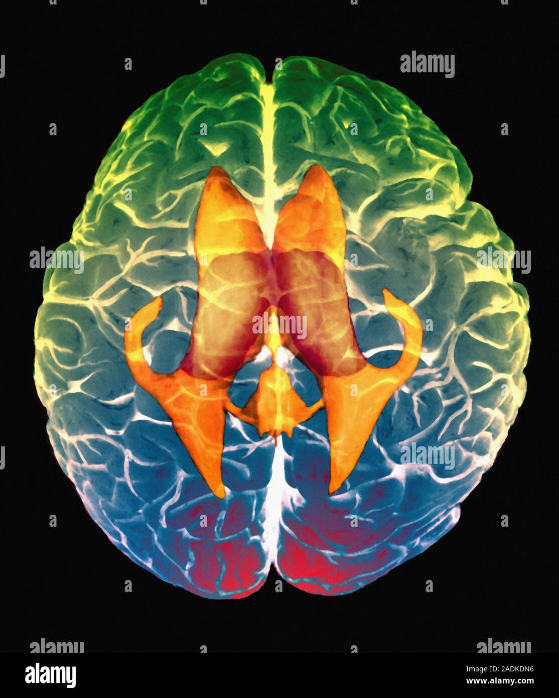 Ventricles of brain. Coloured composite 3-D magnetic resonance imaging (MRI) scan of a human ...