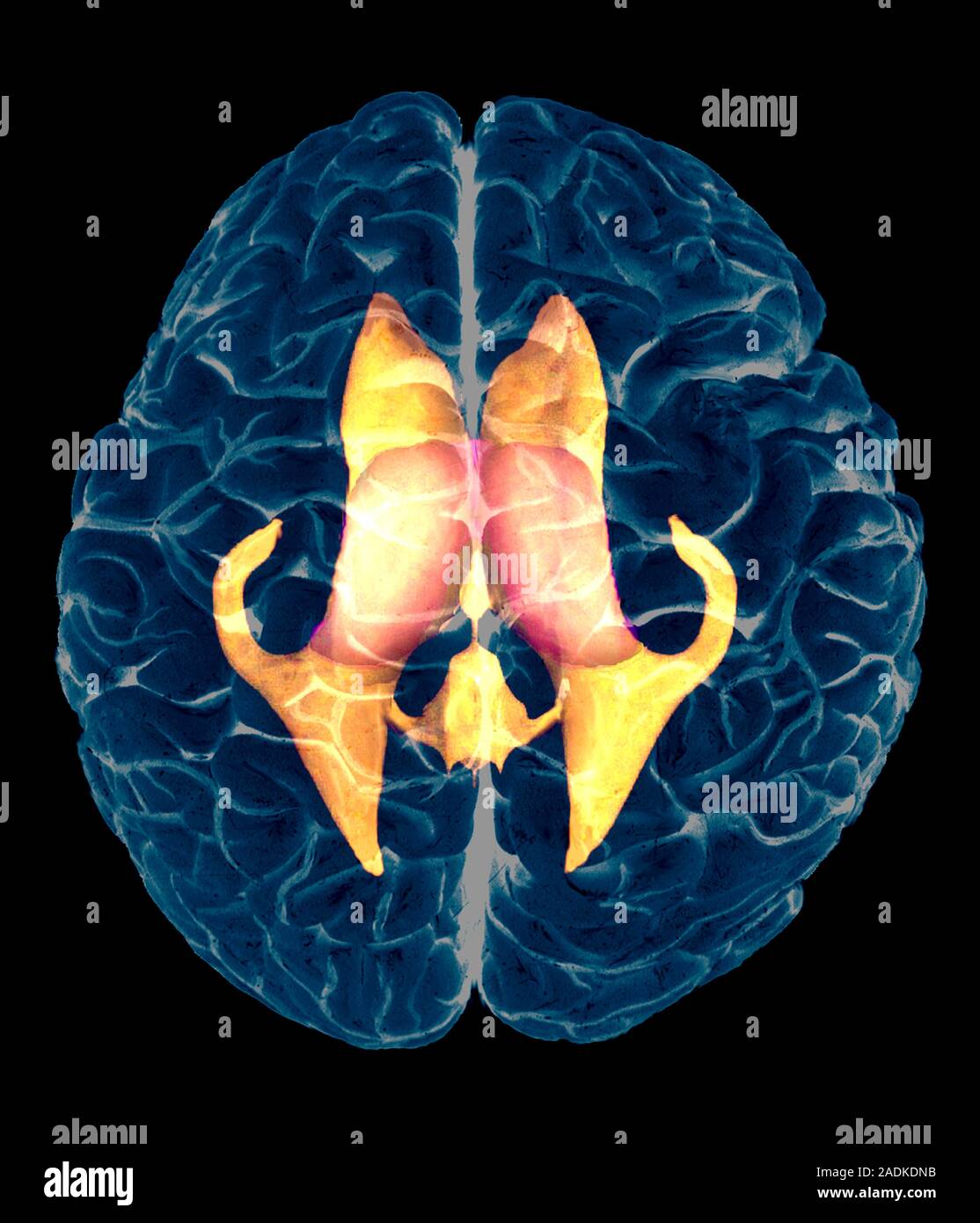 Ventricles of brain. Coloured composite 3-D magnetic resonance imaging (MRI) scan of a human ...