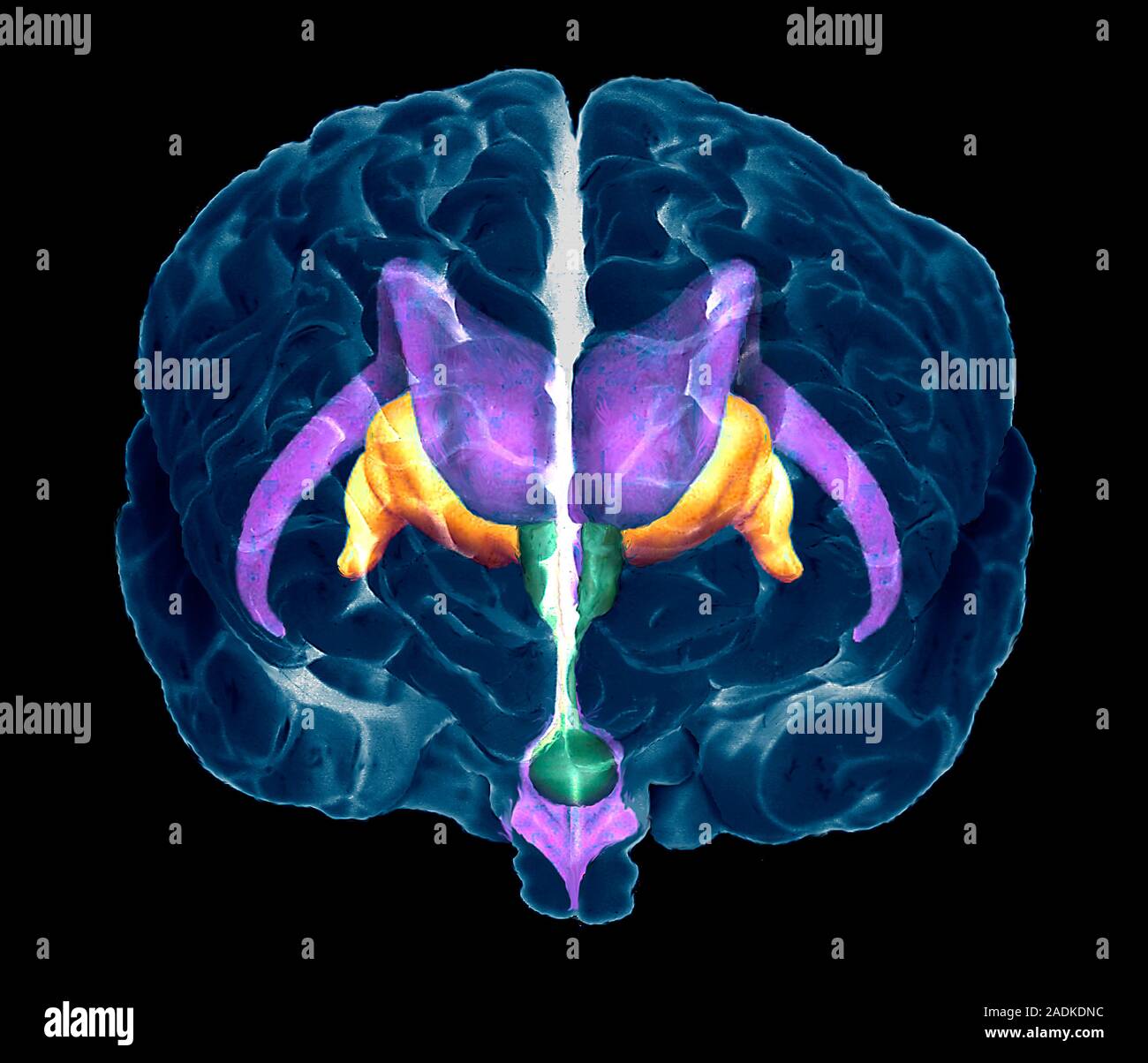 Brain Coloured Composite 3 D Magnetic Resonance Imaging Mri Scan Of