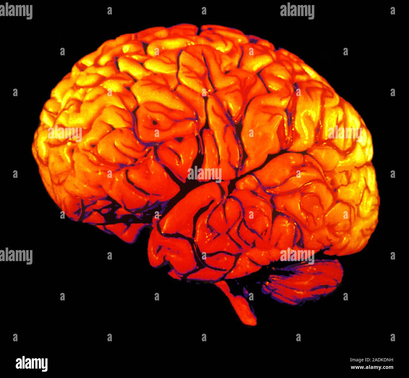 Brain. Coloured three-dimensional magnetic resonance imaging (MRI) scan of a healthy human brain ...