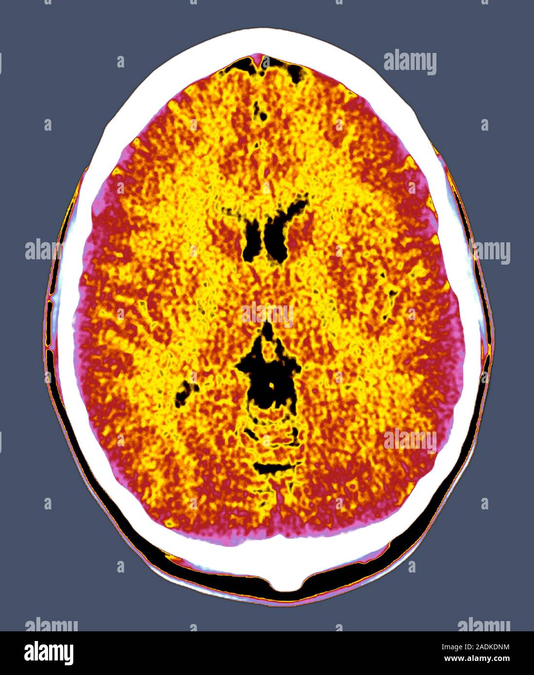 Healthy brain. Coloured computed tomography (CT) scan through a human head showing a healthy ...