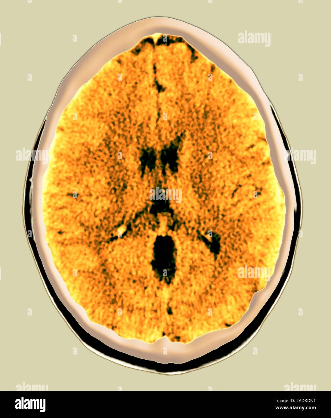 Healthy brain. Coloured computed tomography (CT) scan through a human ...