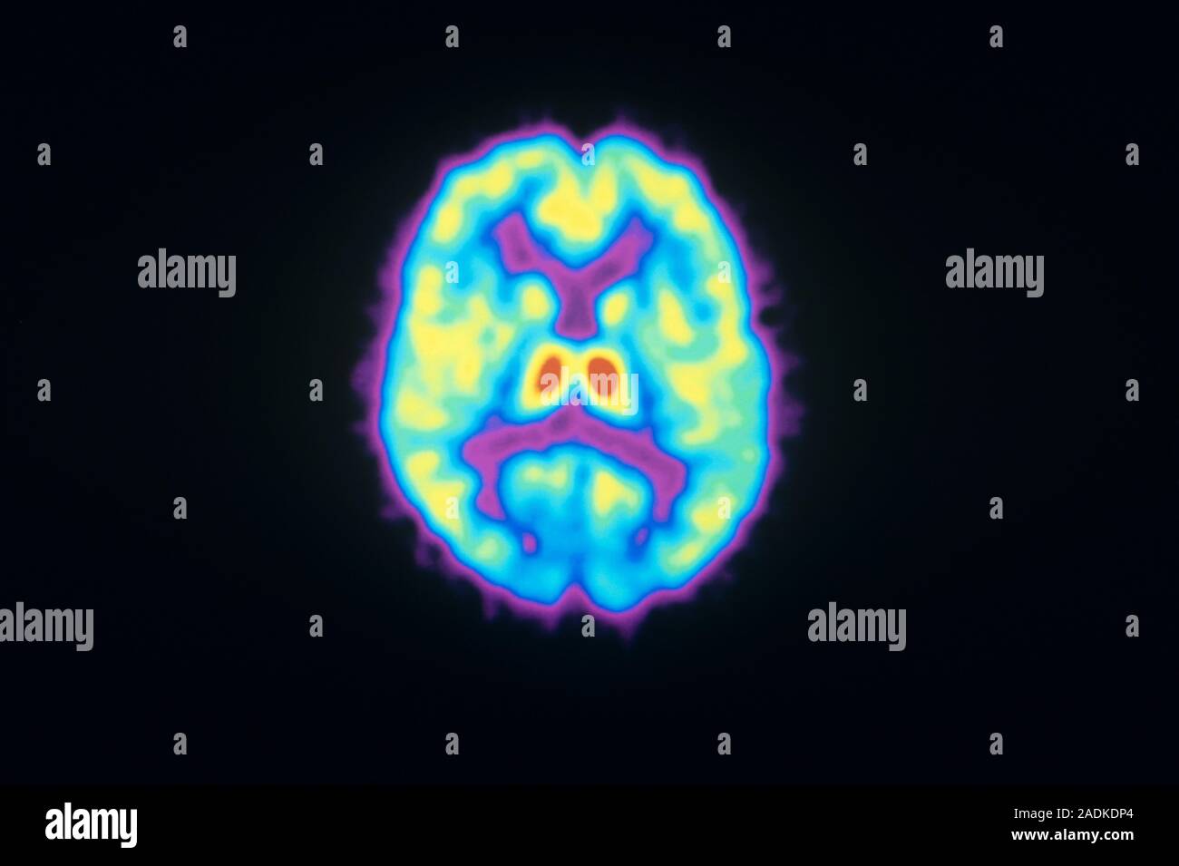 Opioid receptors. Coloured transverse Positron Emission Tomography (PET ...