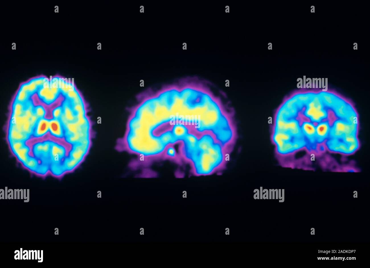 Opioid receptors. Three coloured Positron Emission Tomography (PET ...