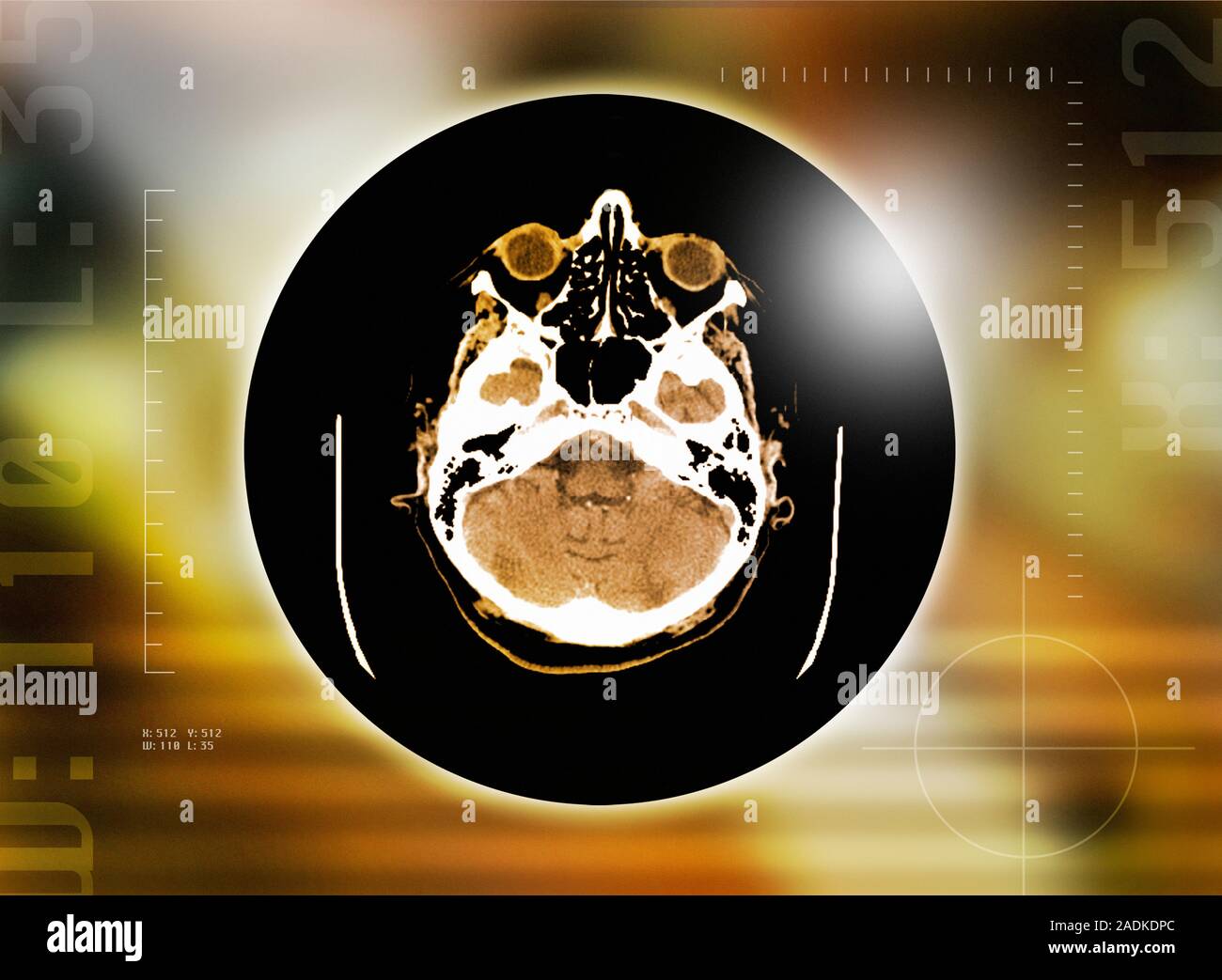 Healthy brain, coloured computed tomography (CT) scan. The front of the ...