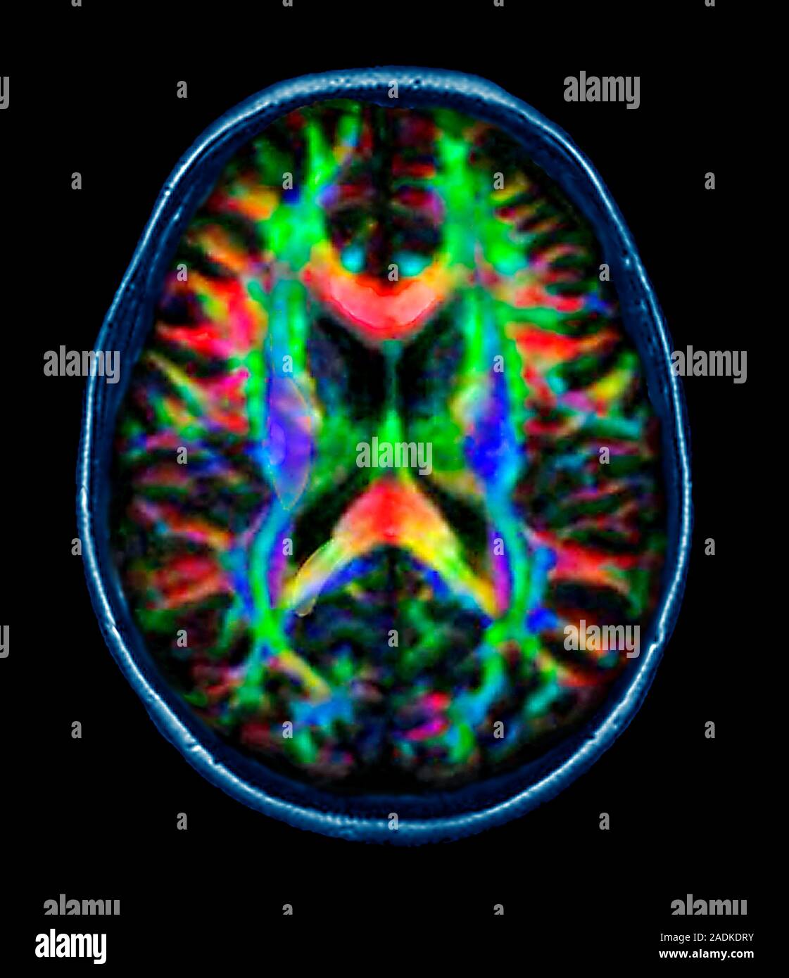White matter fibres. Coloured diffusion tensor imaging (DTI) scan of a section through a healthy ...