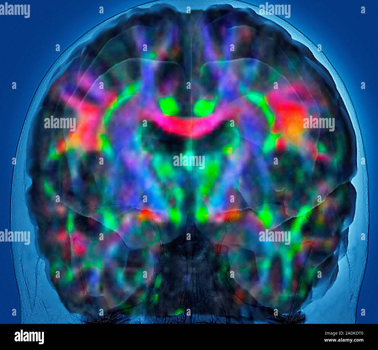 White matter fibres. Coloured diffusion tensor imaging (DTI) scan of a section through a healthy ...