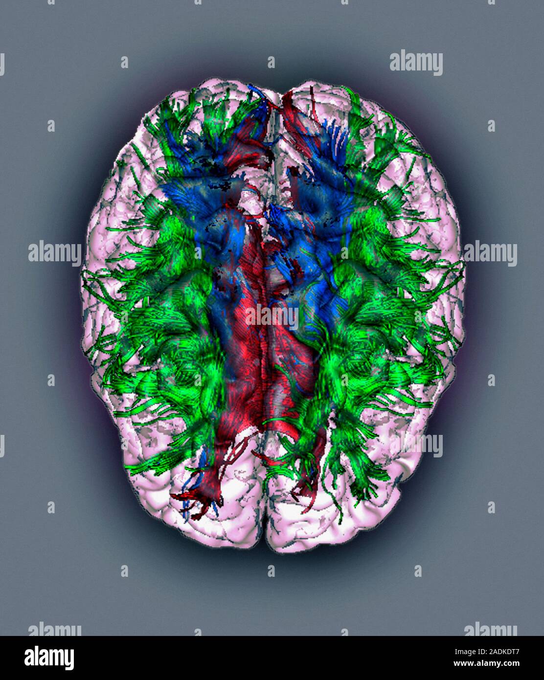 White matter fibres. Coloured 3D diffusion tensor imaging (DTI) scan of a healthy brain, seen ...