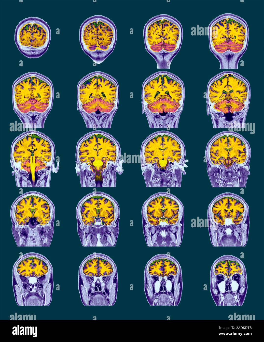 Healthy brain. Coloured magnetic resonance imaging (MRI) scans through ...