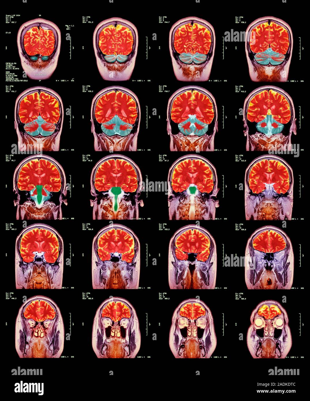 Healthy brain. Coloured magnetic resonance imaging (MRI) scans through ...