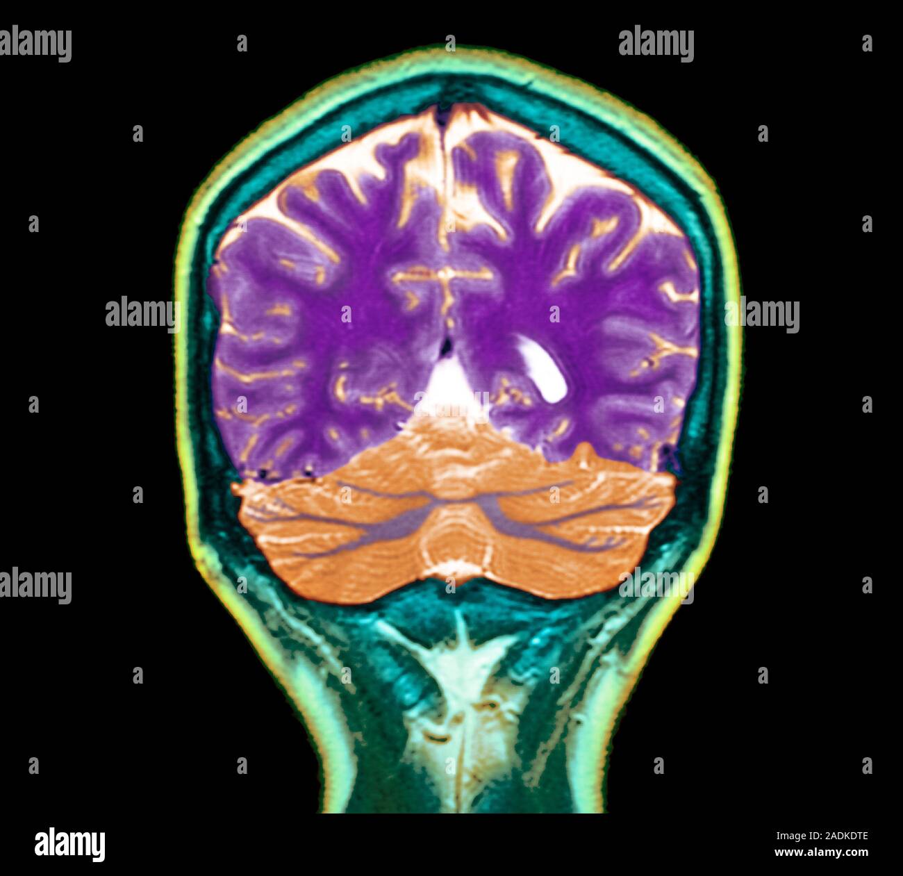 Healthy brain. Coloured magnetic resonance imaging (MRI) scan through ...